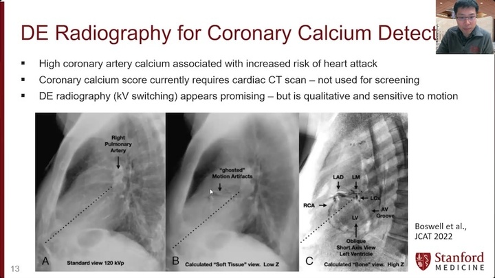 Coronary Artery Calcium Detection from Dual-Energy Radiography - CVIT ...